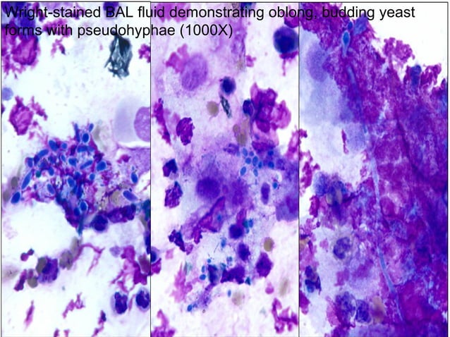 Bal fluid analysis | PPT | Lung and Respiratory Health | Diseases and ...