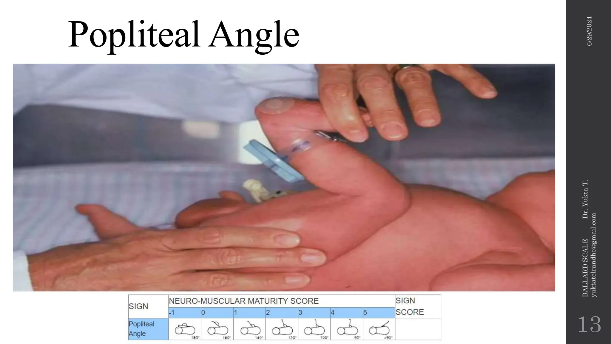 BALLARD SCALE Maturational assessment of gestational age .pptx