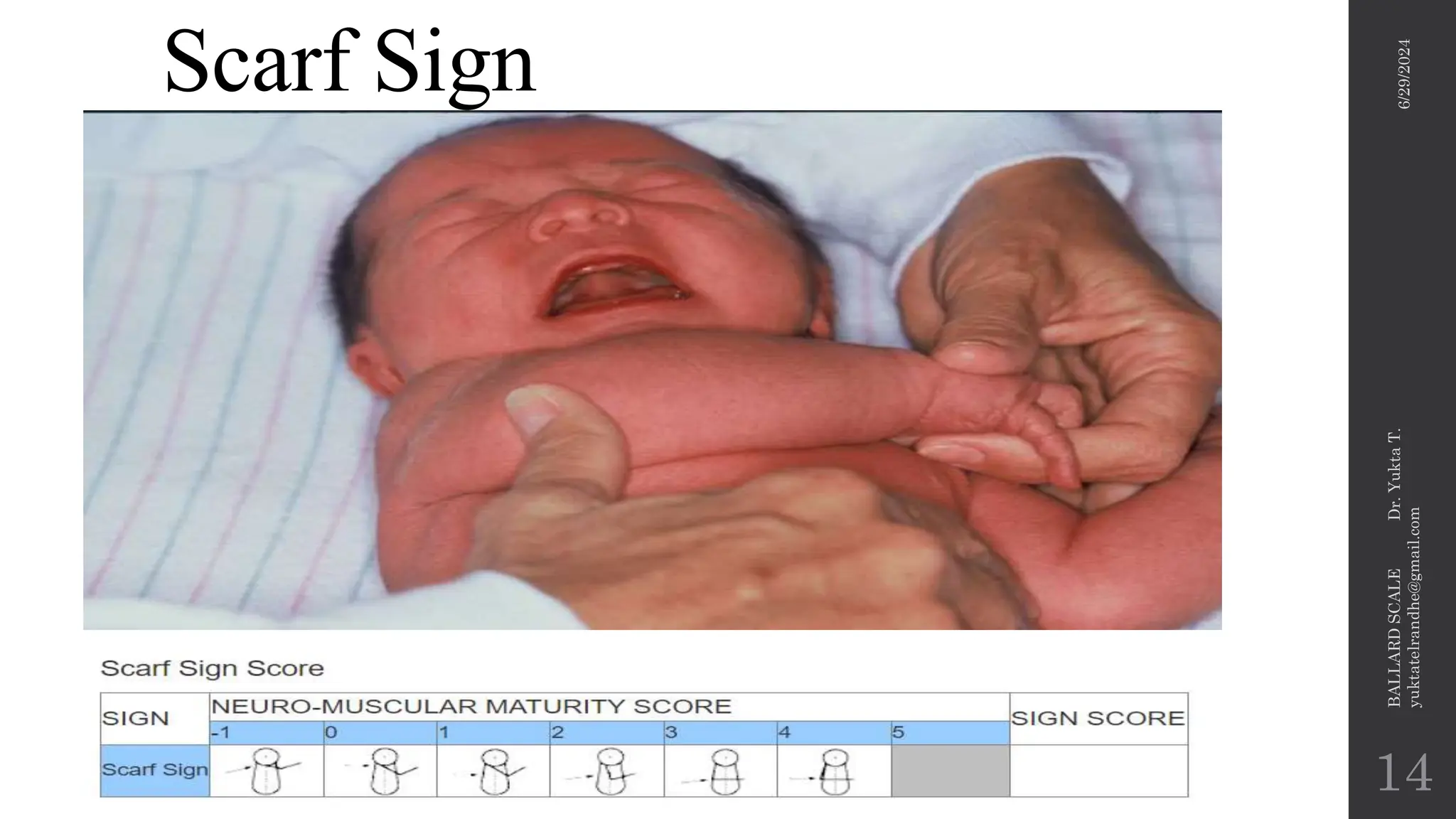 BALLARD SCALE Maturational assessment of gestational age .pptx
