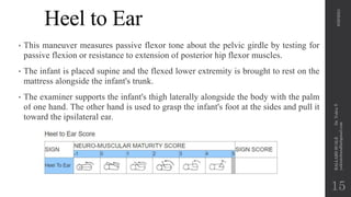 BALLARD SCALE Maturational assessment of gestational age .pptx