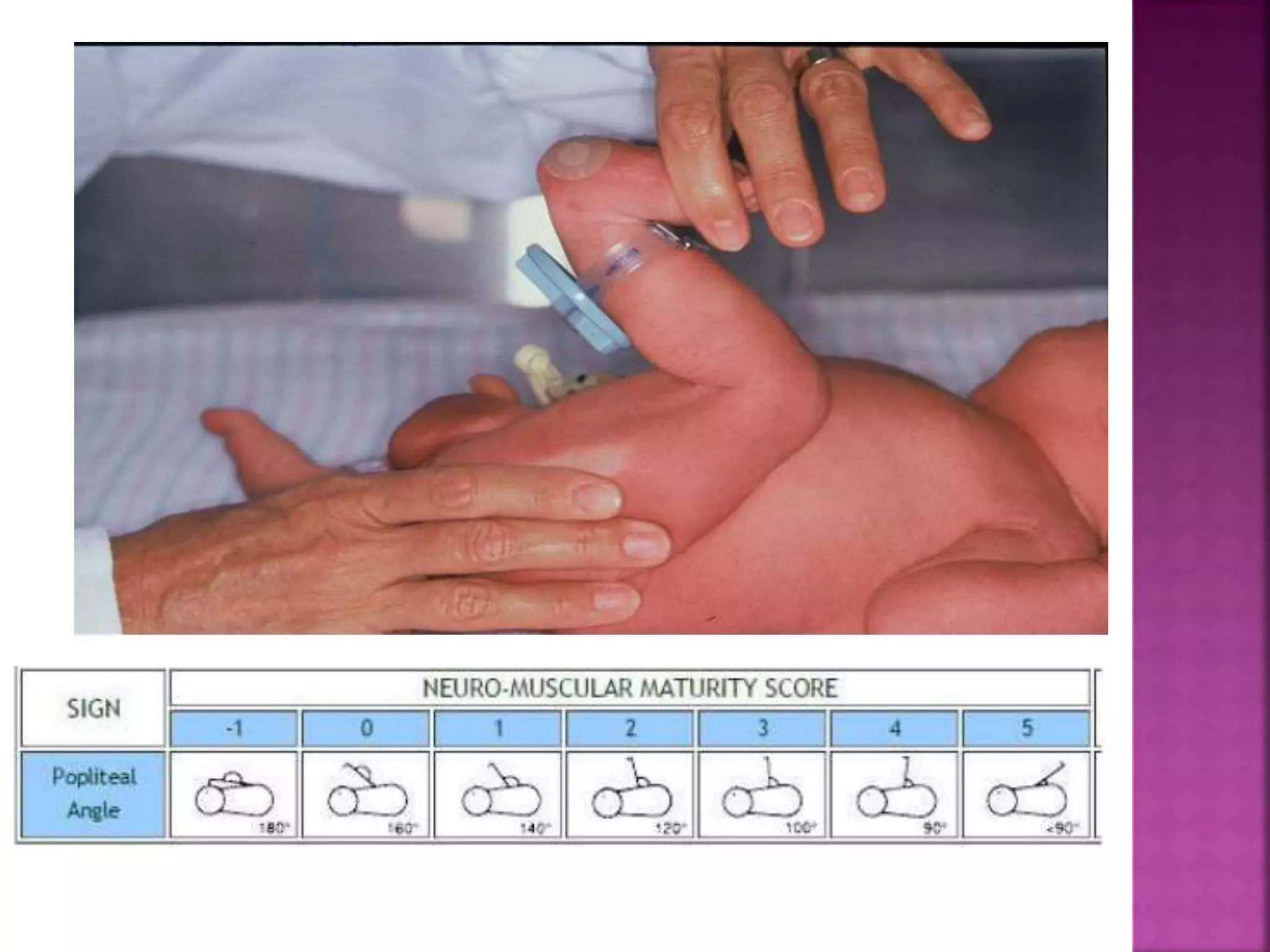 Ballard scale presentation | PPTX