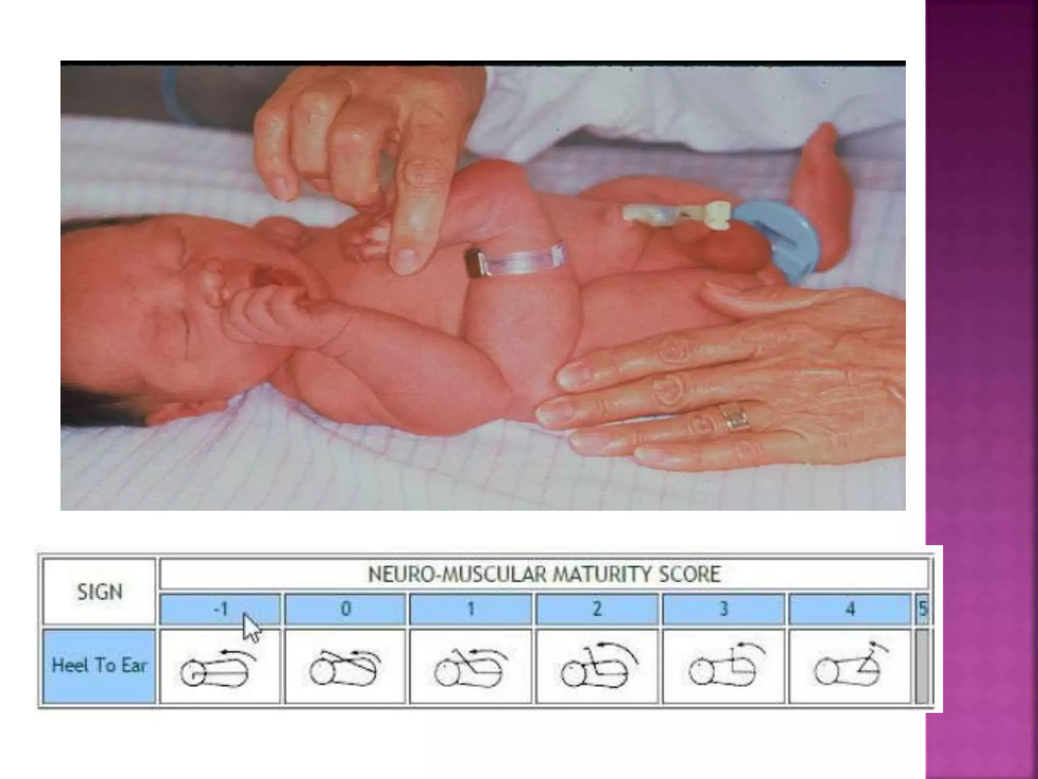Ballard scale presentation | PPTX
