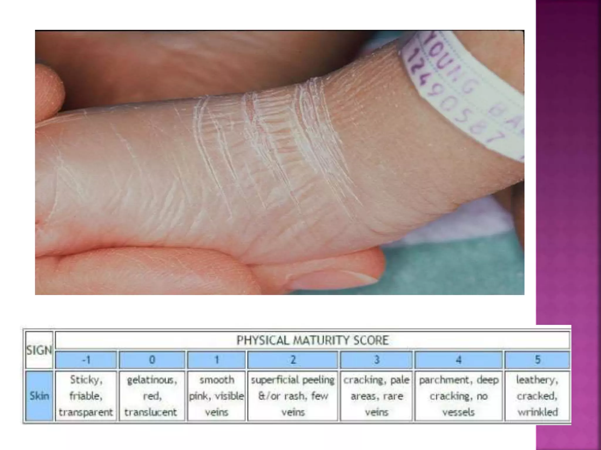 Ballard scale presentation | PPTX