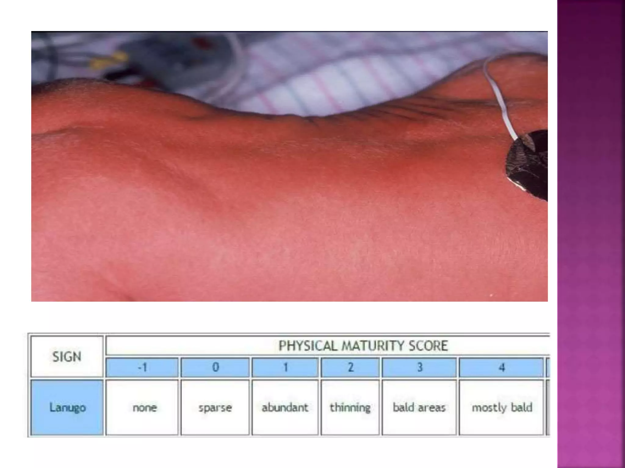 Ballard scale presentation | PPTX