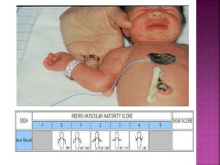 Ballard scale presentation | PPTX