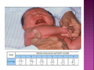 Ballard scale presentation | PPTX