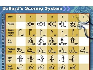 BALLARD SCORING AND INTERPRETATION ON PHYSICAL AND NEURO MATURITY | PPT