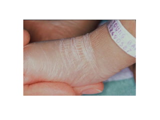 Ballard score.. - Dr Padmesh - Neonatology | PPTX