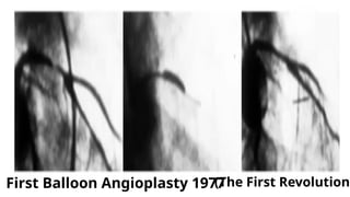 Balloon Angioplasty Basics (Ahmed AlRefaiy). | PPTX
