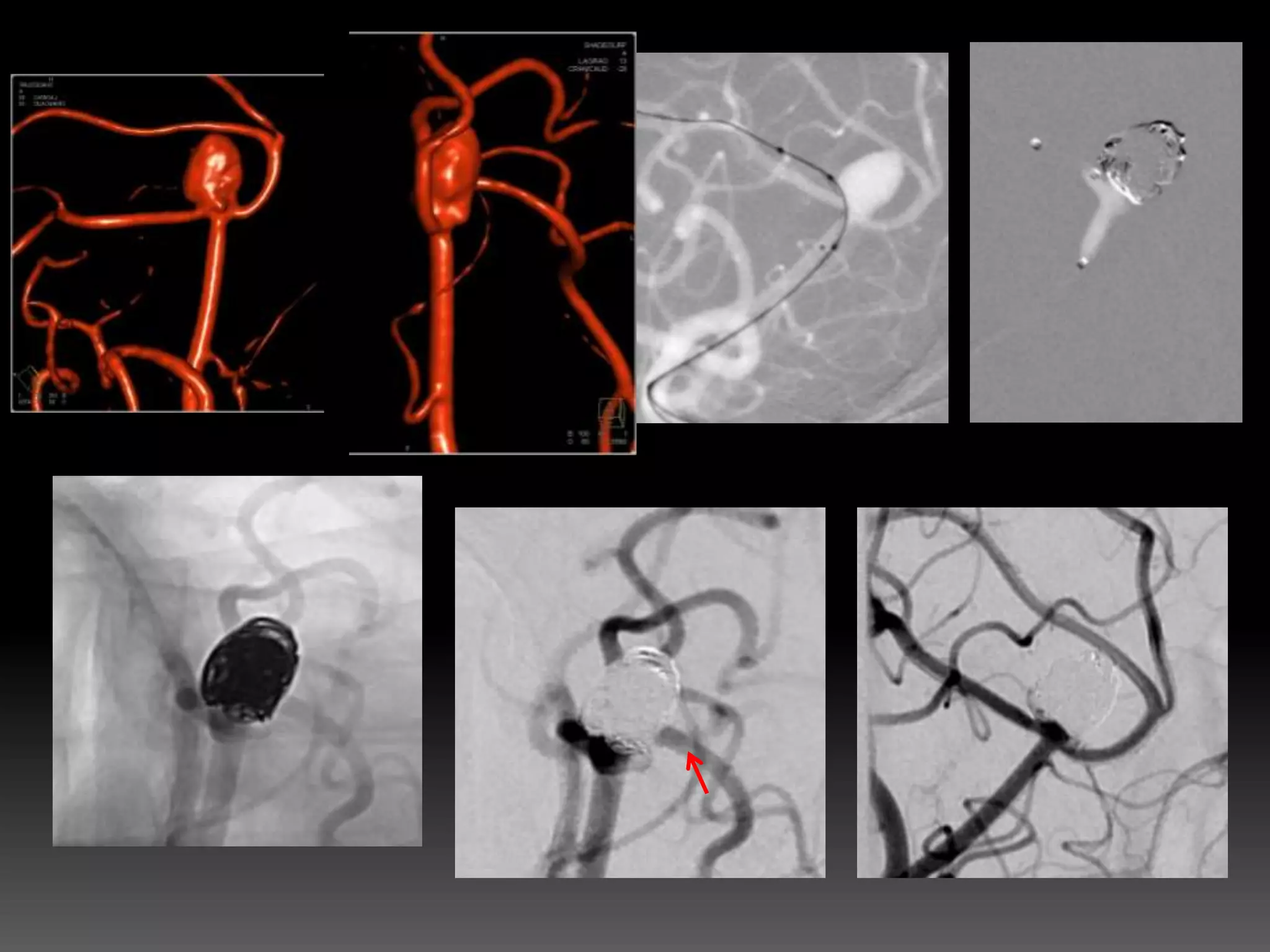 Balloon Assisted Coiling in Ruptured Cerebral Aneurysms | PPTX