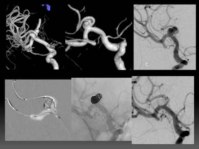 Balloon Assisted Coiling in Ruptured Cerebral Aneurysms | PPT