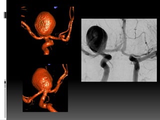 Balloon Assisted Coiling in Ruptured Cerebral Aneurysms | PPT