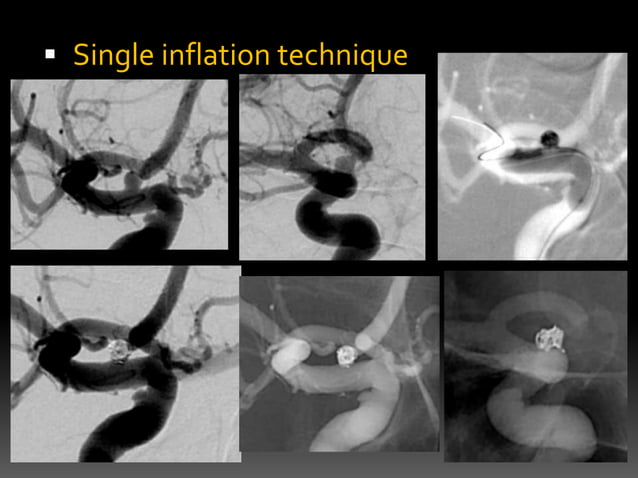 Balloon Assisted Coiling in Ruptured Cerebral Aneurysms | PPT
