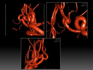Balloon Assisted Coiling in Ruptured Cerebral Aneurysms | PPT