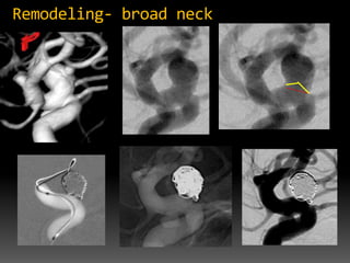 Balloon Assisted Coiling in Ruptured Cerebral Aneurysms | PPT