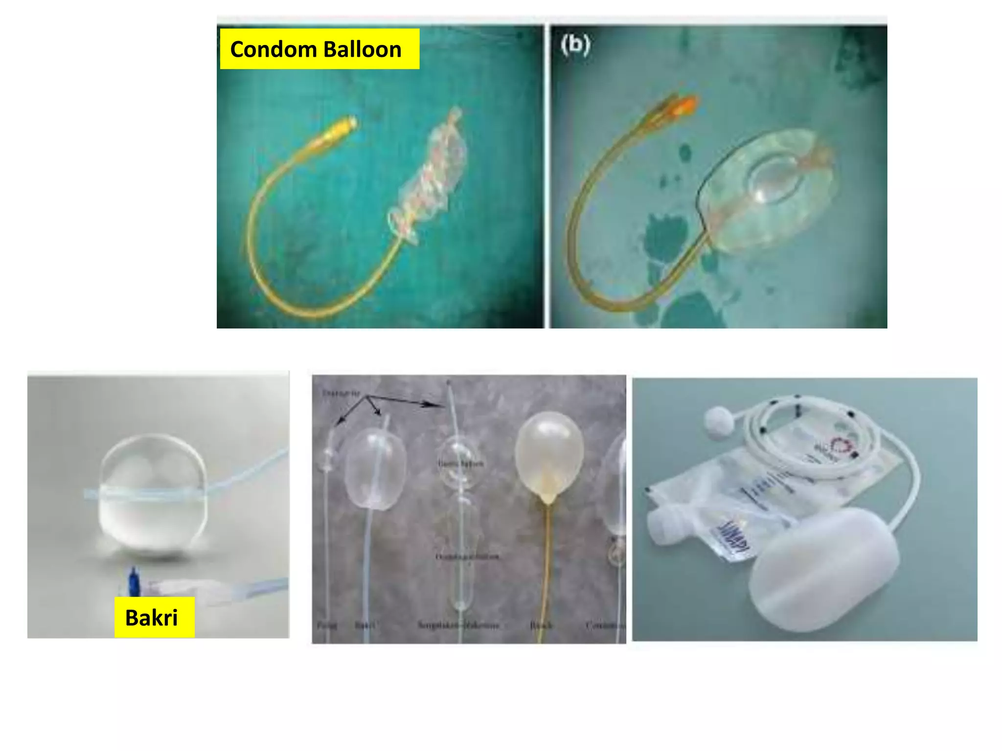 Balloon Tamponade in Post partum Hemorrhage Dr Sharda Jain Dr Jyoti ...