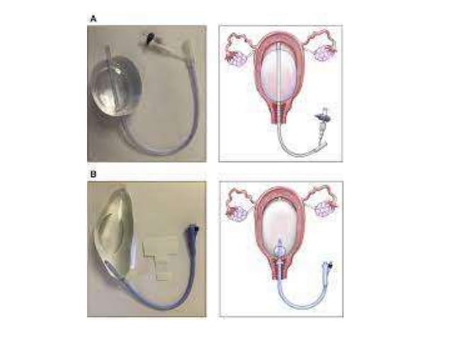 Balloon Tamponade in Post partum Hemorrhage Dr Sharda Jain Dr Jyoti ...