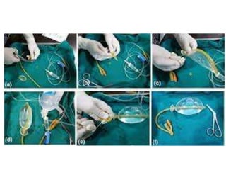 Balloon Tamponade in Post partum Hemorrhage Dr Sharda Jain Dr Jyoti ...