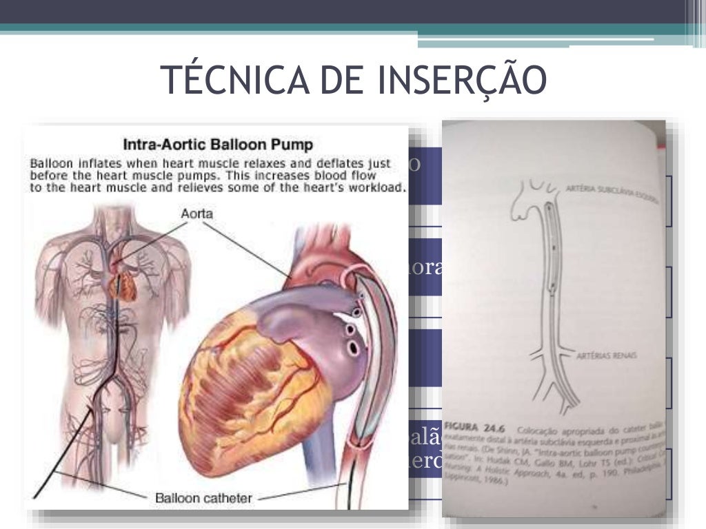 Balão Intra-aórtico Cuidados De Enfermagem - RETOEDU