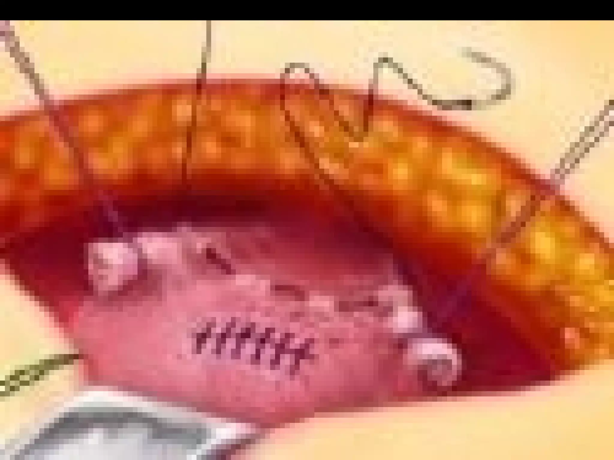 Total abdominal hysterectomy with bilateral salpingo-oophorectomy. | PPT