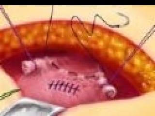 Total abdominal hysterectomy with bilateral salpingo-oophorectomy. | PPT