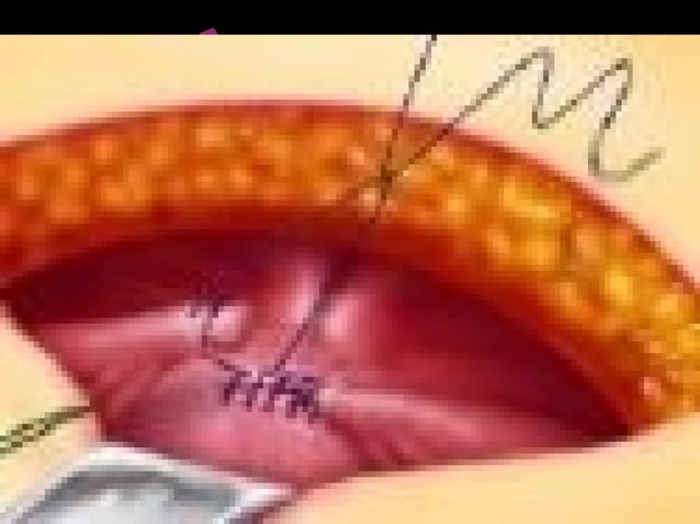 Total Abdominal Hysterectomy With Bilateral Salpingo Oophorectomy
