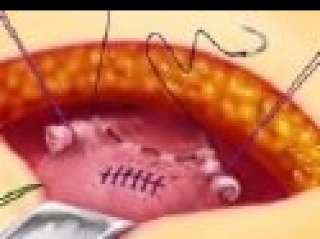 Total Abdominal Hysterectomy With Bilateral Salpingo Oophorectomy