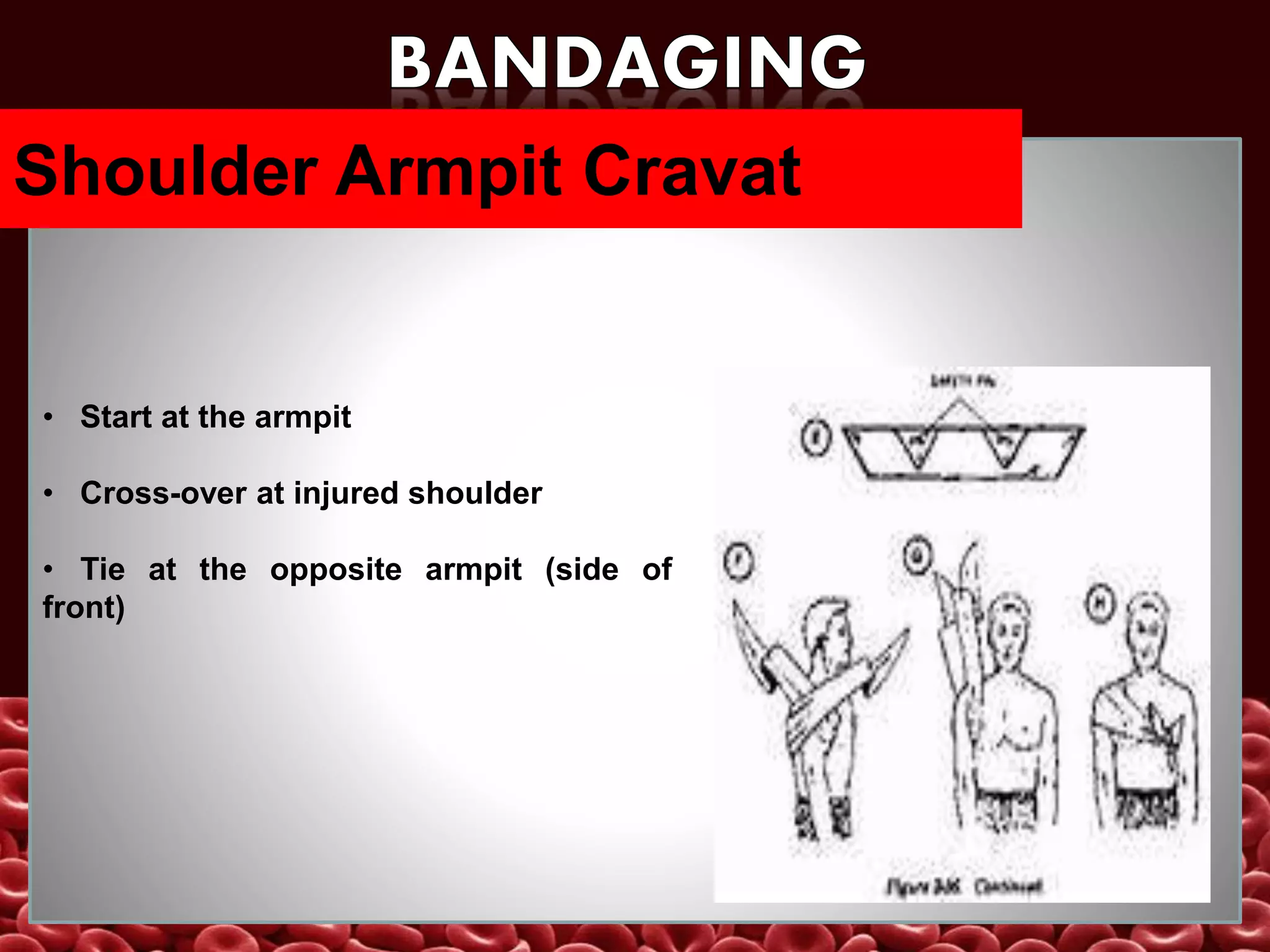 bandage.ppt
