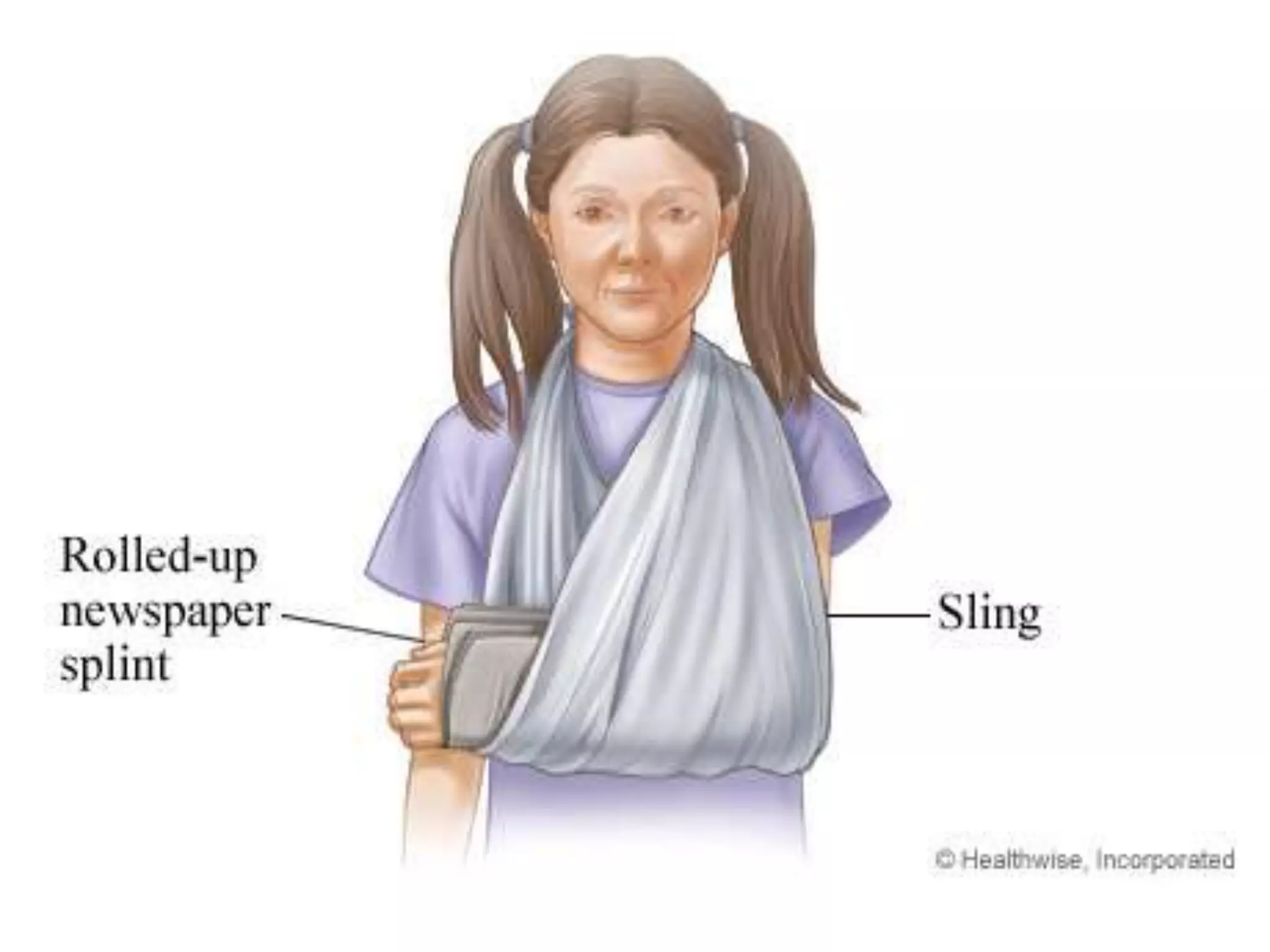 Bandaging and Splinting & Slings; Techniques and Types (Health Subject ...