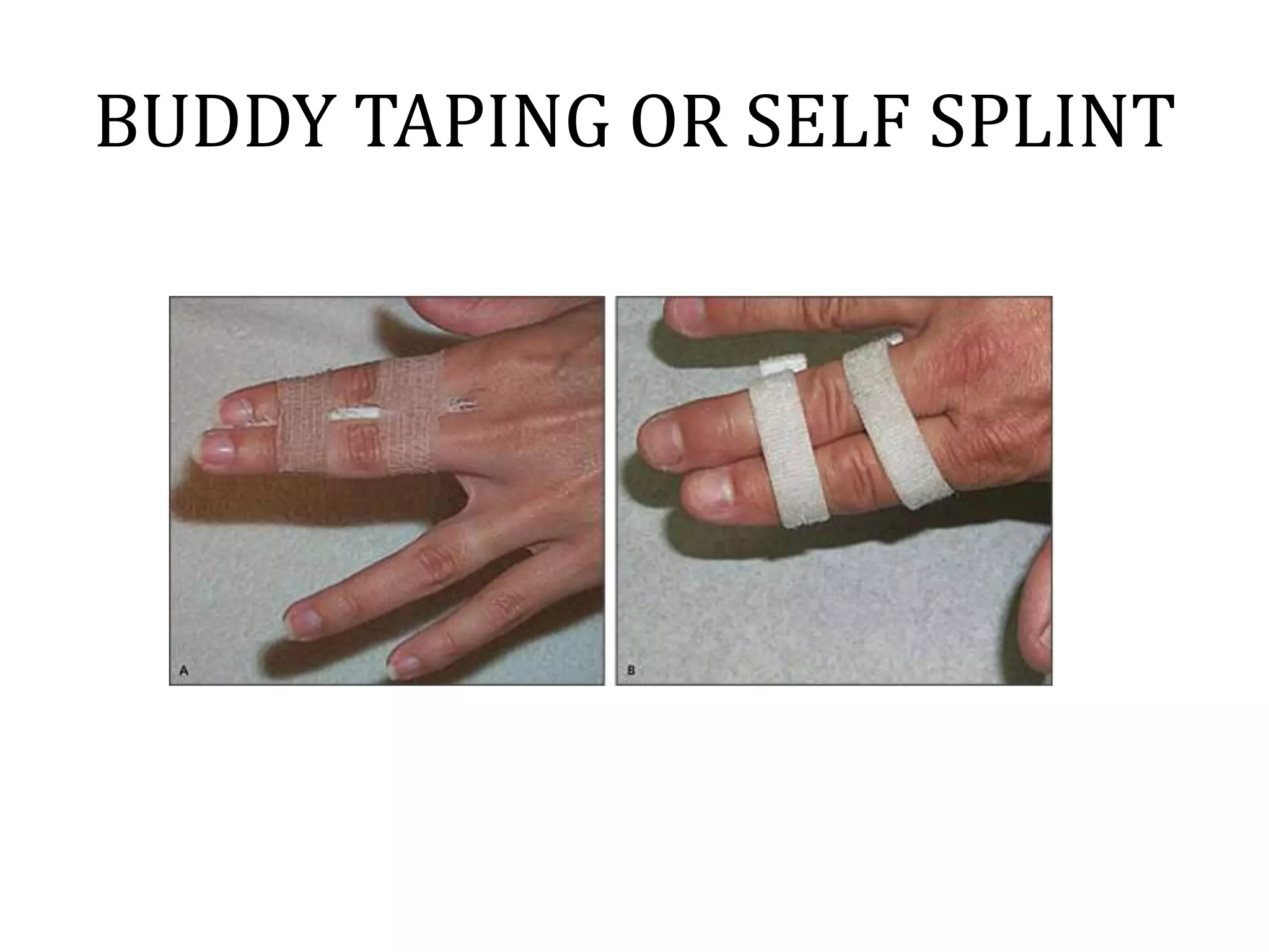 Bandaging and Splinting & Slings; Techniques and Types (Health Subject ...