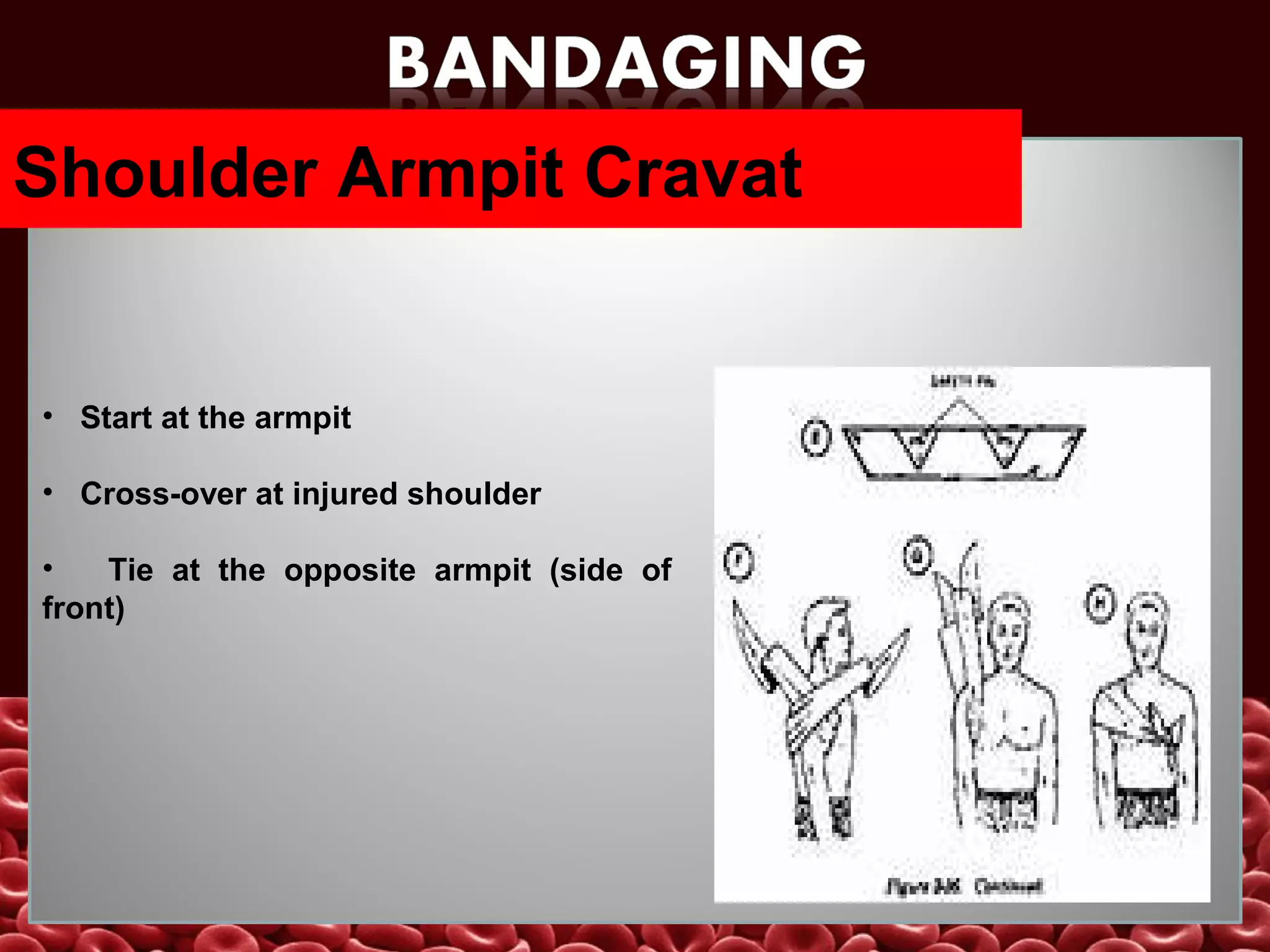Bandaging&splinting | PPT