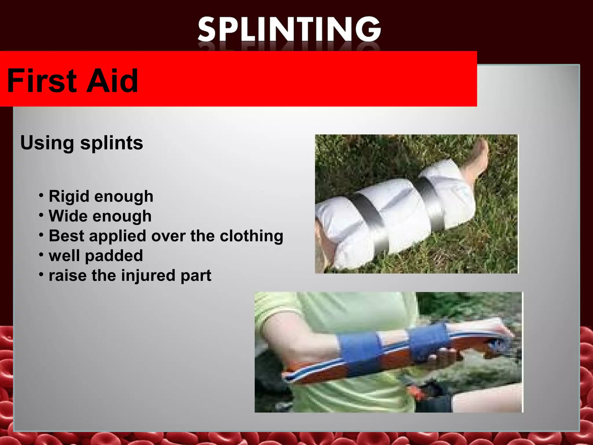 Bandaging&splinting | PPT