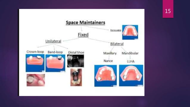 Band and loop space maintainer | PPTX | Dental Health | Diseases and Conditions