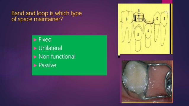 Band and loop space maintainer | PPTX | Dental Health | Diseases and ...