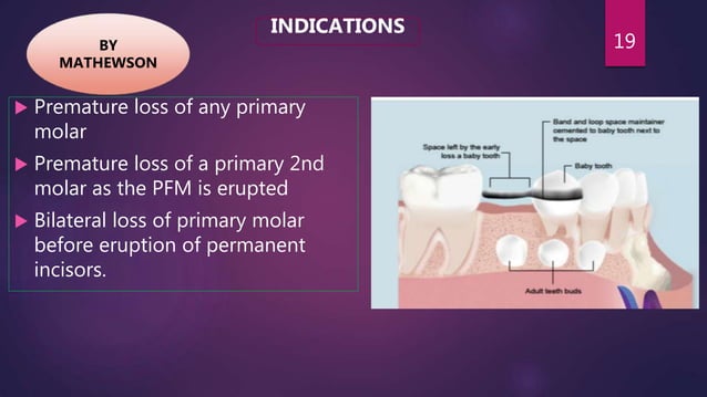 Band and loop space maintainer | PPTX | Dental Health | Diseases and ...