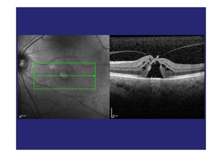 Bandello classifications of vitreo macular tractions | PDF