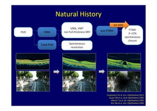 Bandello pharmacological treatment of vitreo macular traction | PDF ...