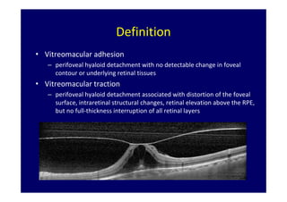 Bandello pharmacological treatment of vitreo macular traction | PDF