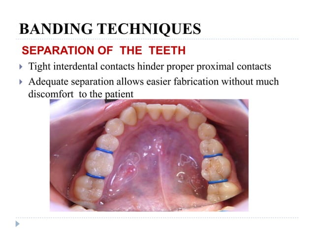 Banding | PPTX | Dental Health | Diseases and Conditions