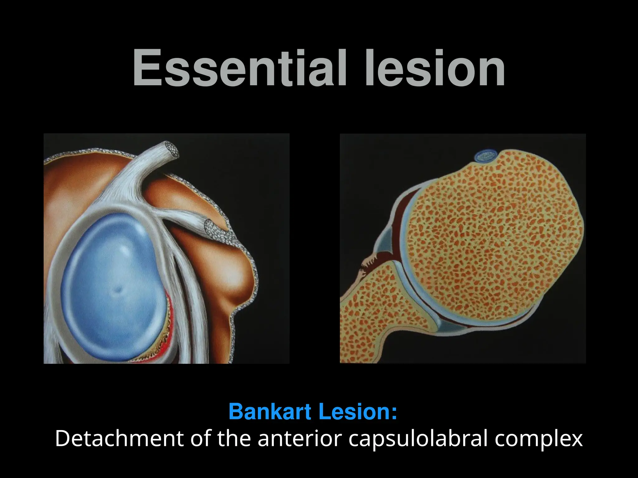 Bankart & Hill Sachs lesions and their repairs | PPTX