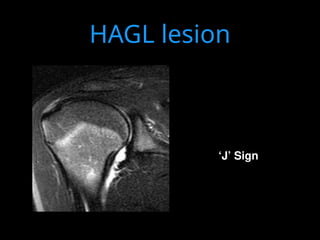 Bankart & Hill Sachs lesions and their repairs | PPTX