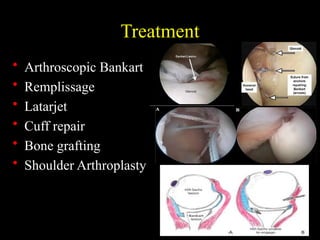 Bankart & Hill Sachs lesions and their repairs | PPTX
