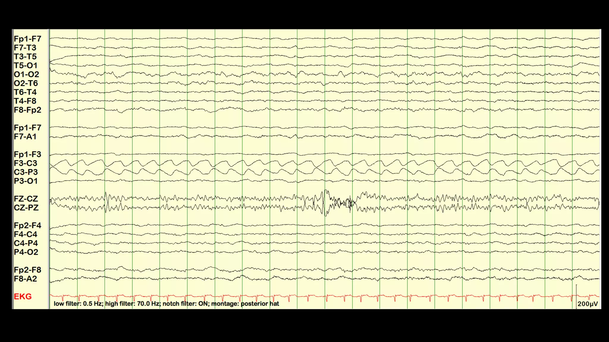 Eeg Artifact And How To Resolve Pptx