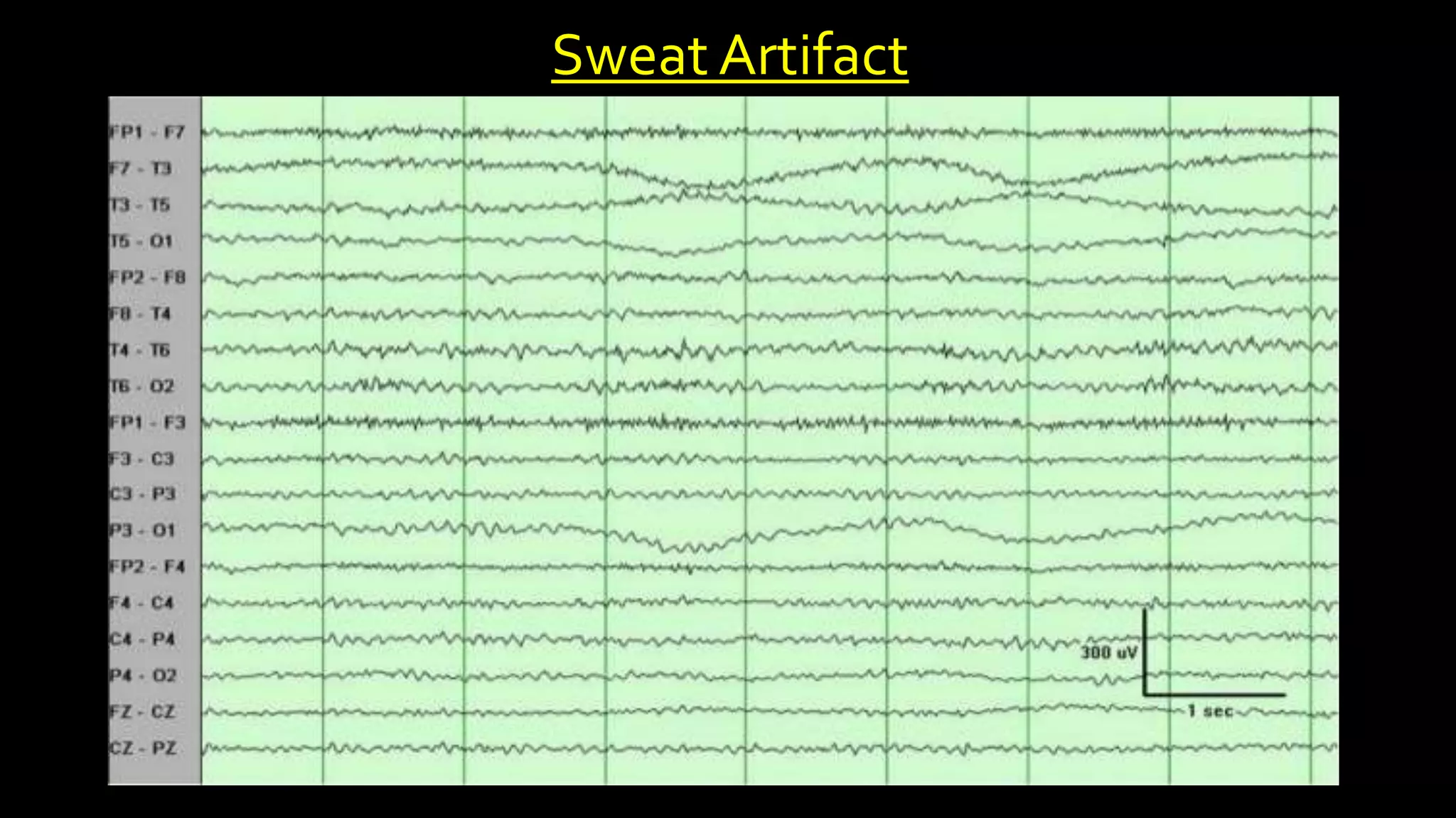 EEG Artifact and How to Resolve | PPTX