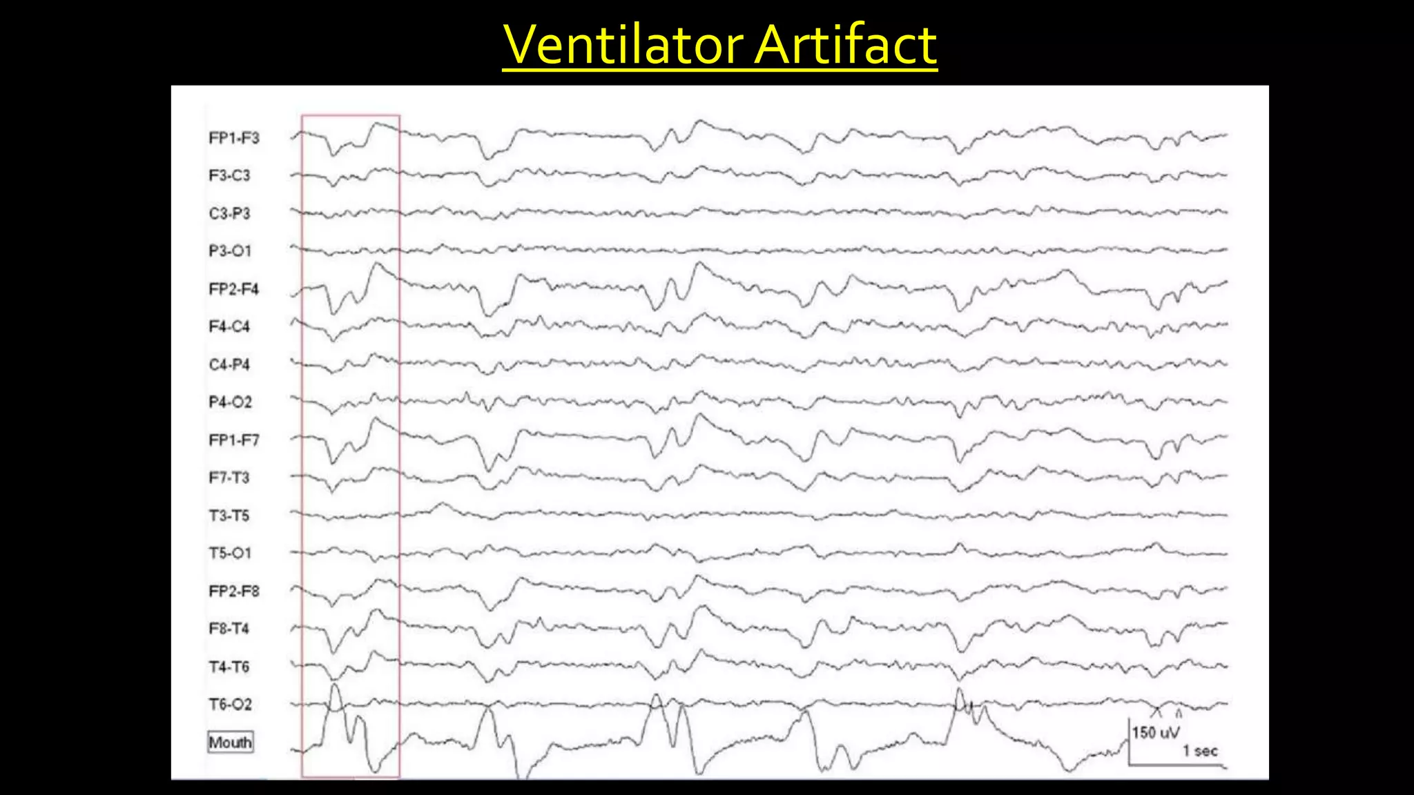 Eeg Artifact And How To Resolve Pptx