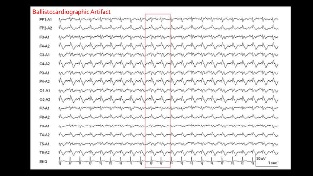 Eeg Artifact And How To Resolve Pptx