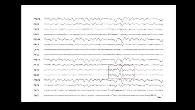 EEG Artifact and How to Resolve | PPTX