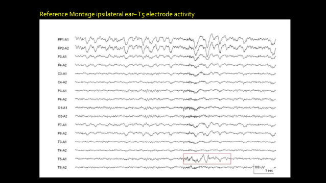 EEG Artifact and How to Resolve | PPTX