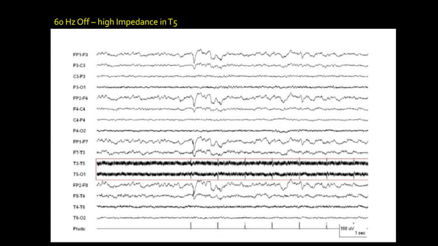 Eeg Artifact And How To Resolve Pptx