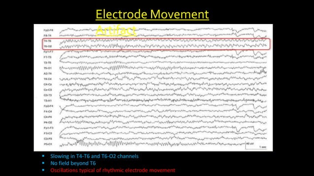 EEG Artifact and How to Resolve | PPTX